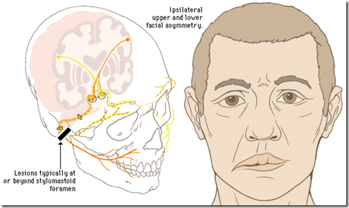 Bells Pares (Perifer facialispares) ~ Medicinanteckningar